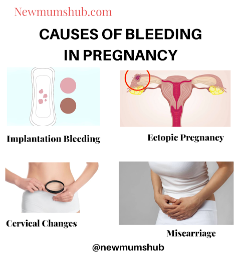 Bleeding In Early Pregnancy Common Causes Symptoms Pulse Nigeria bleeding-in-early-pregnancy-common-causes-symptoms-pulse-nigeria