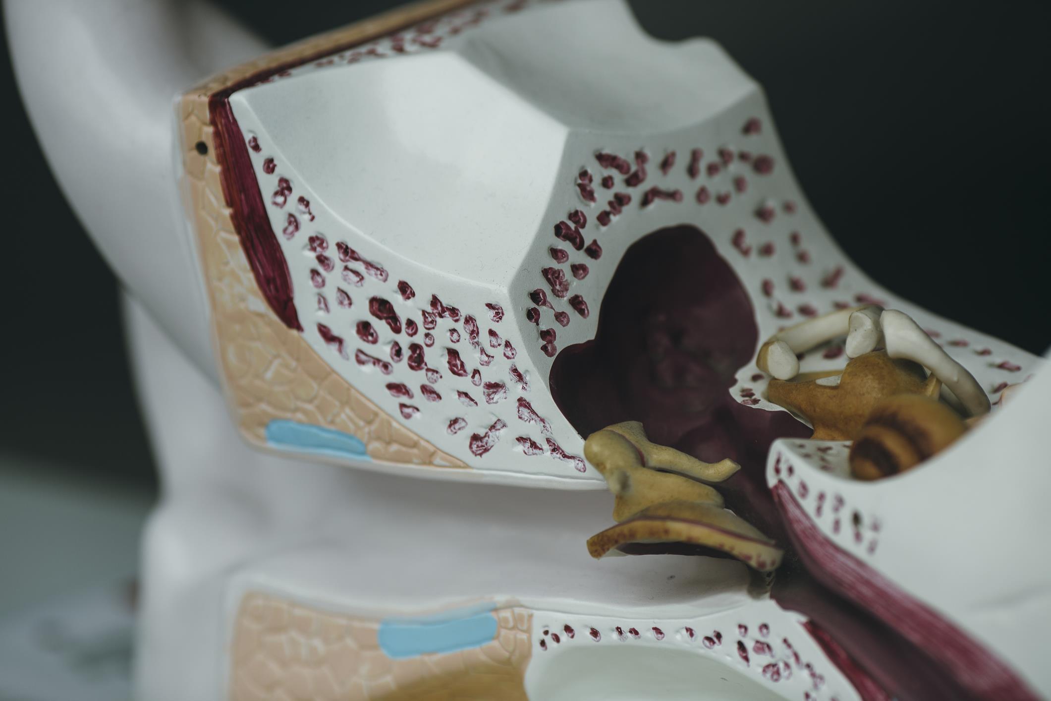 Otoskleroza ucha (otospongioza) - objawy, leczenie, operacja