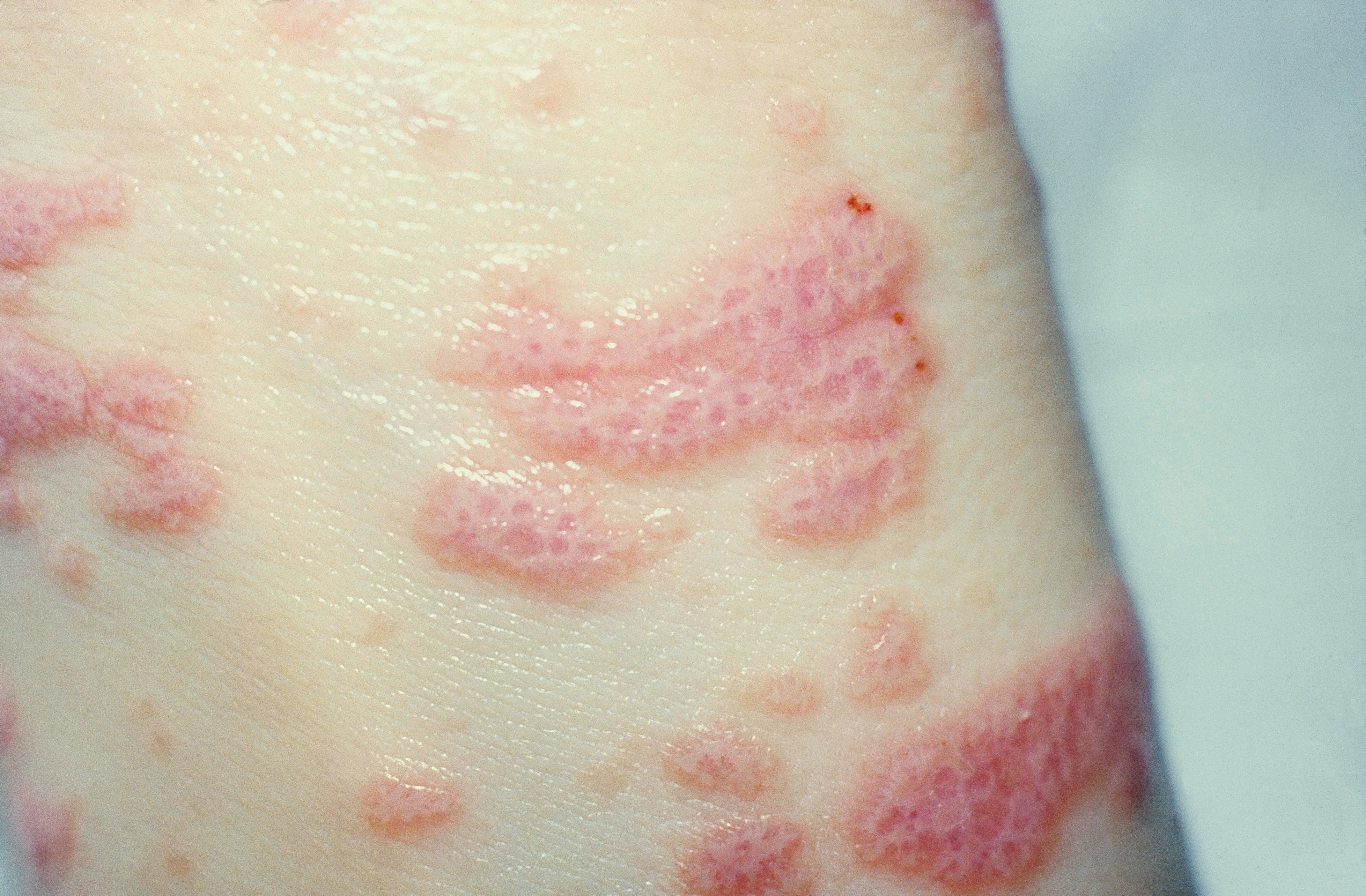 Dolegliwości skórne. Schorzenia skóry. Jak rozpoznać choroby skóry ...