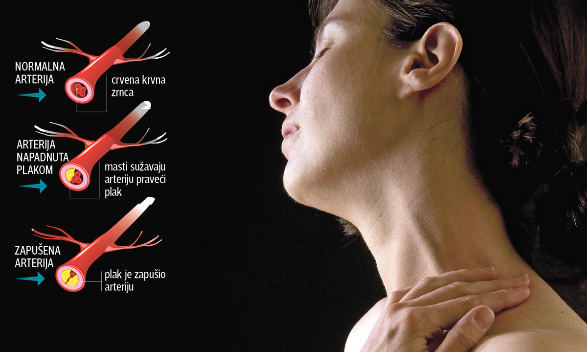 Kako da sačuvate arterije - Žena.rs