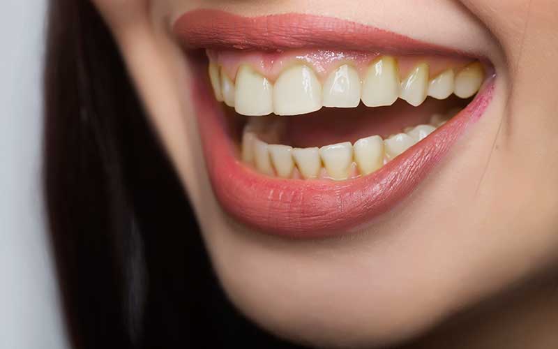 Yellow Teeth