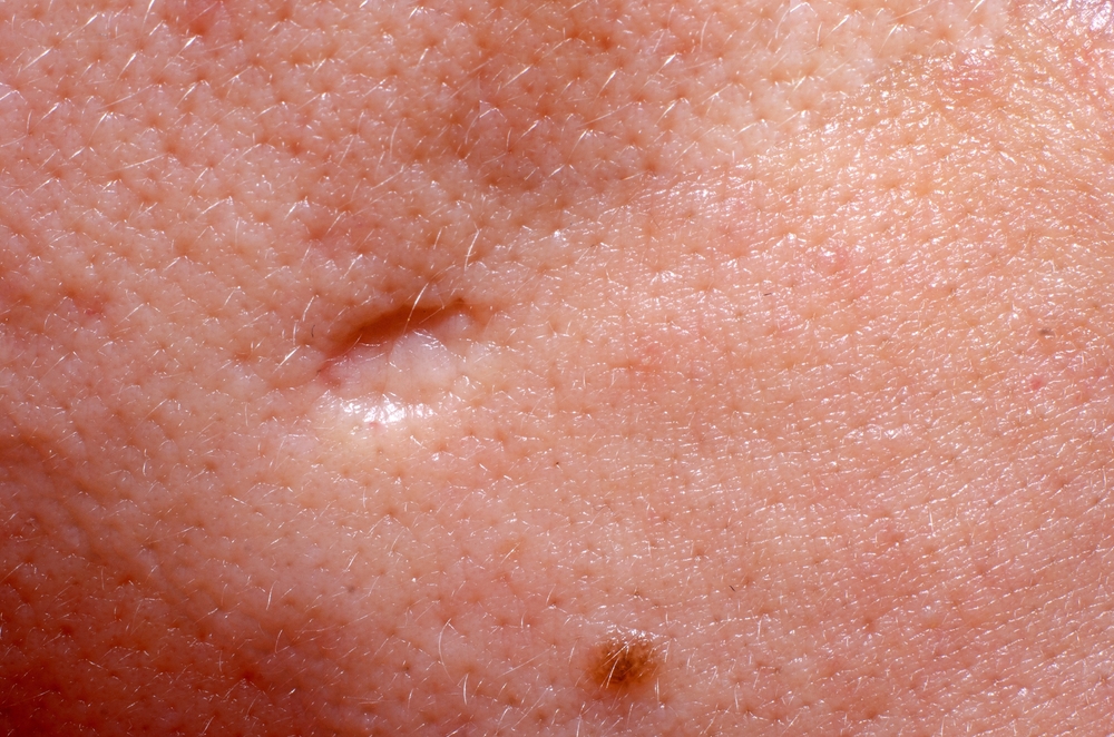 Bőrrák: a basalioma eleinte egy egyszerű sebnek is tűnhet | EgészségKalauz