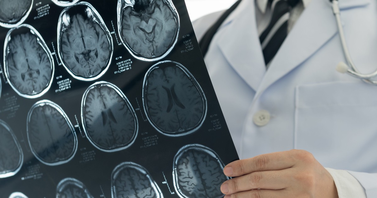 The coronavirus may cause brain damage, even in patients with mild ...