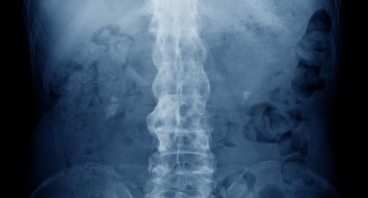 Zesztywniające zapalenie stawów kręgosłupa (ZZSK) - objawy, leczenie