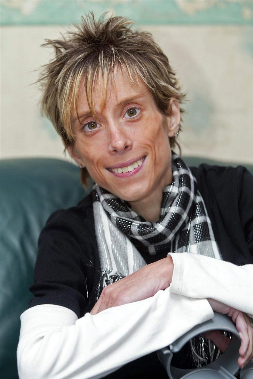 Mandy Sellars - zespół proteusza, choroba genetyczna