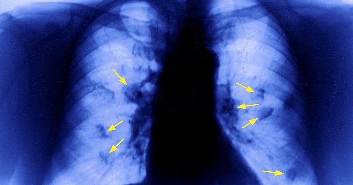 Płuca palacza - jak wyglądają?