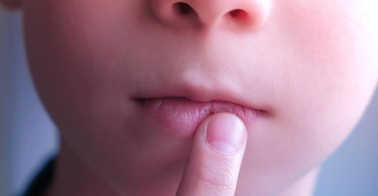 Opryszczka u dzieci - przyczyny, objawy