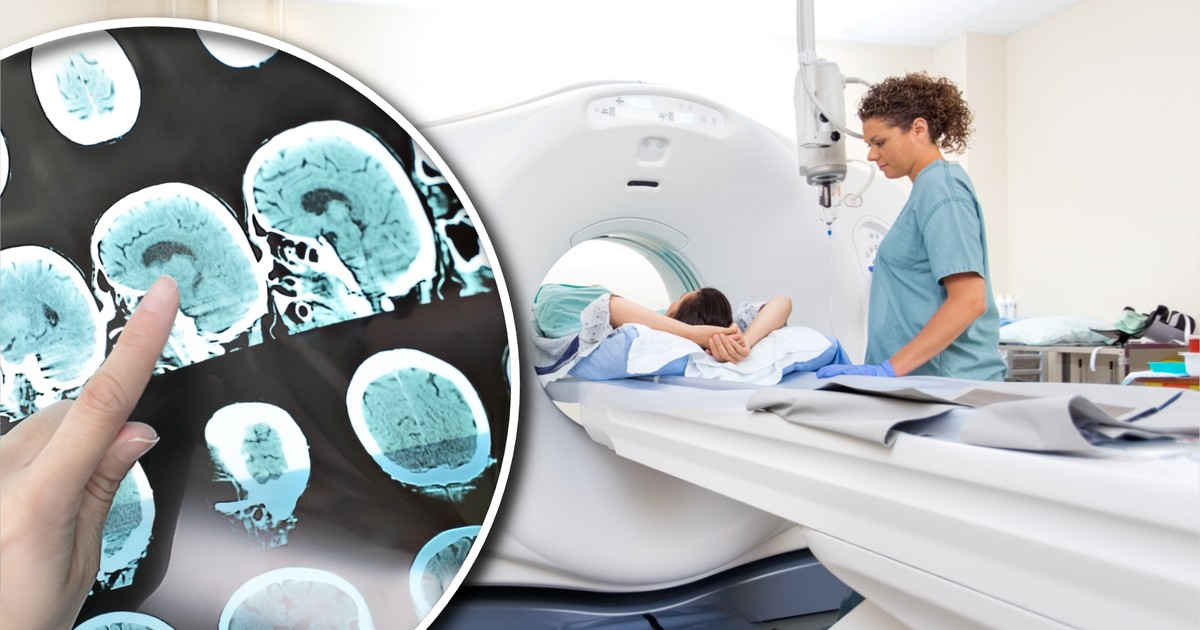 Glejak mózgu to podstępny nowotwór. Jakie są objawy glejaka i rokowania?