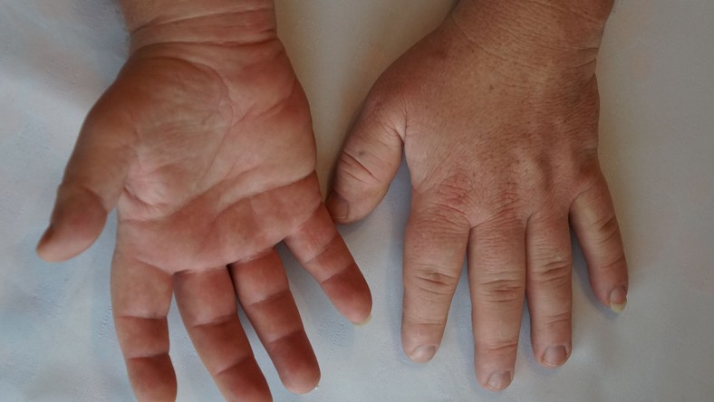 Akromegalia - to nie odmienny wygląd czyni tę chorobę groźną - Dziennik.pl