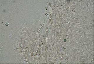 Dermatofitoza