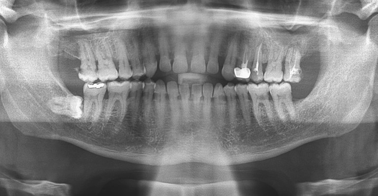 Pantomogram - wskazania, przebieg, rodzaje, interpretacja