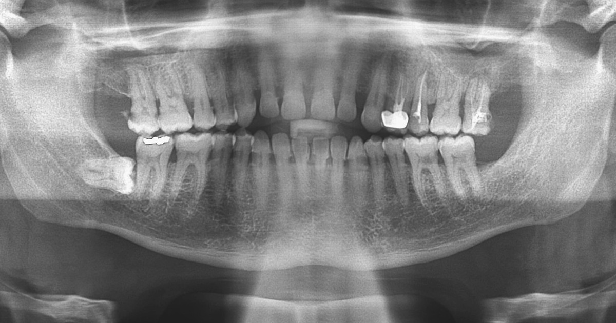 Pantomogram - wskazania, przebieg, rodzaje, interpretacja