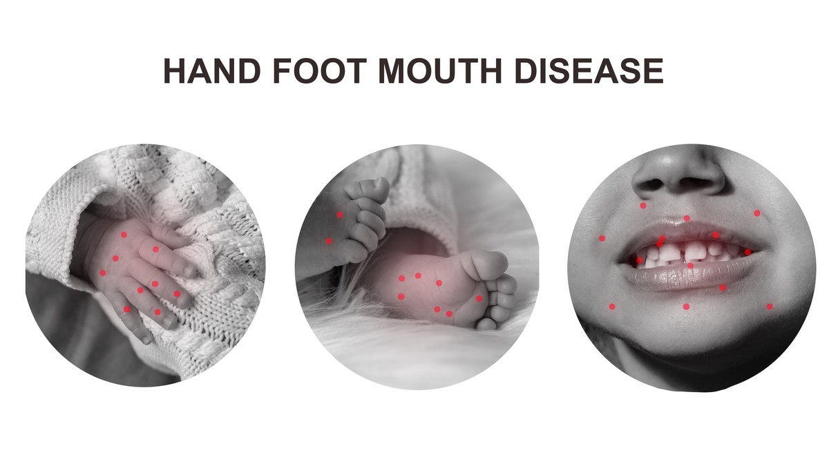 Bolest ruku, nogu i usta (BRNU virus): Kako se prenosi, simptomi i ...