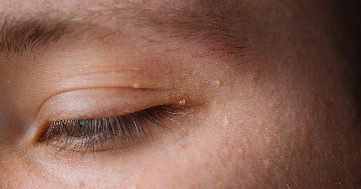 Prosaki - charakterystyka, rozpoznanie, metody usuwania