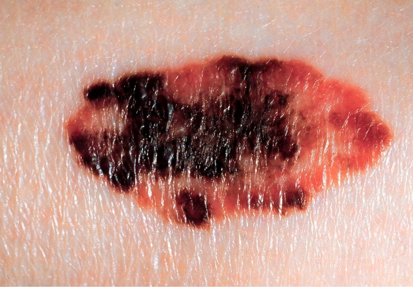 Czerniak. Jak rozpoznać czerniaka. Znamiona. Czy znamię to rak