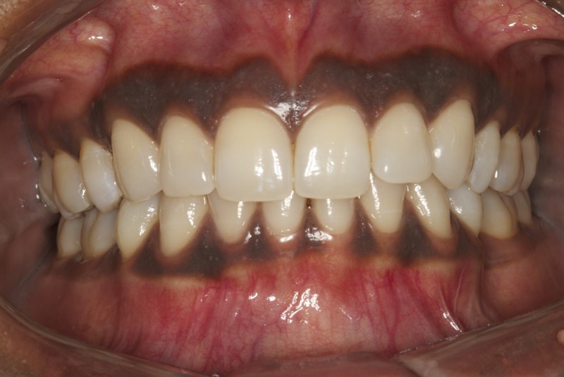 Why some people have black gums | Pulselive Kenya