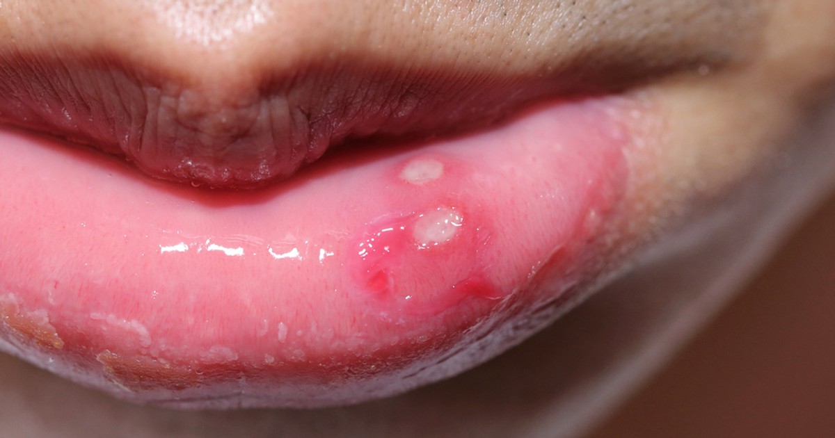 Afta na języku i w jamie ustnej - przyczyny i leczenie domowe afty ...