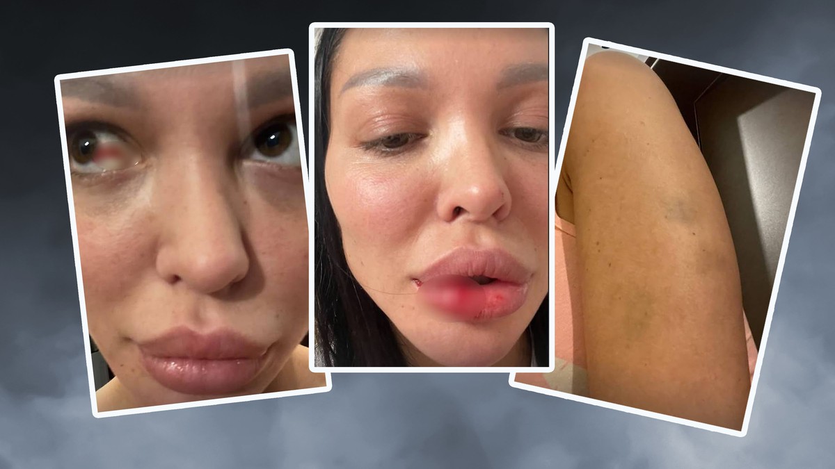 Maji Marinković usna krvava, cela u modricama i podlivima: Tvrdi da joj je povrede naneo Filip ...