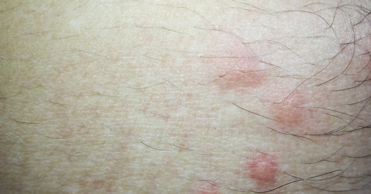 Pchła a pluskwa. Jak rozpoznać ugryzienie? - Kobieta