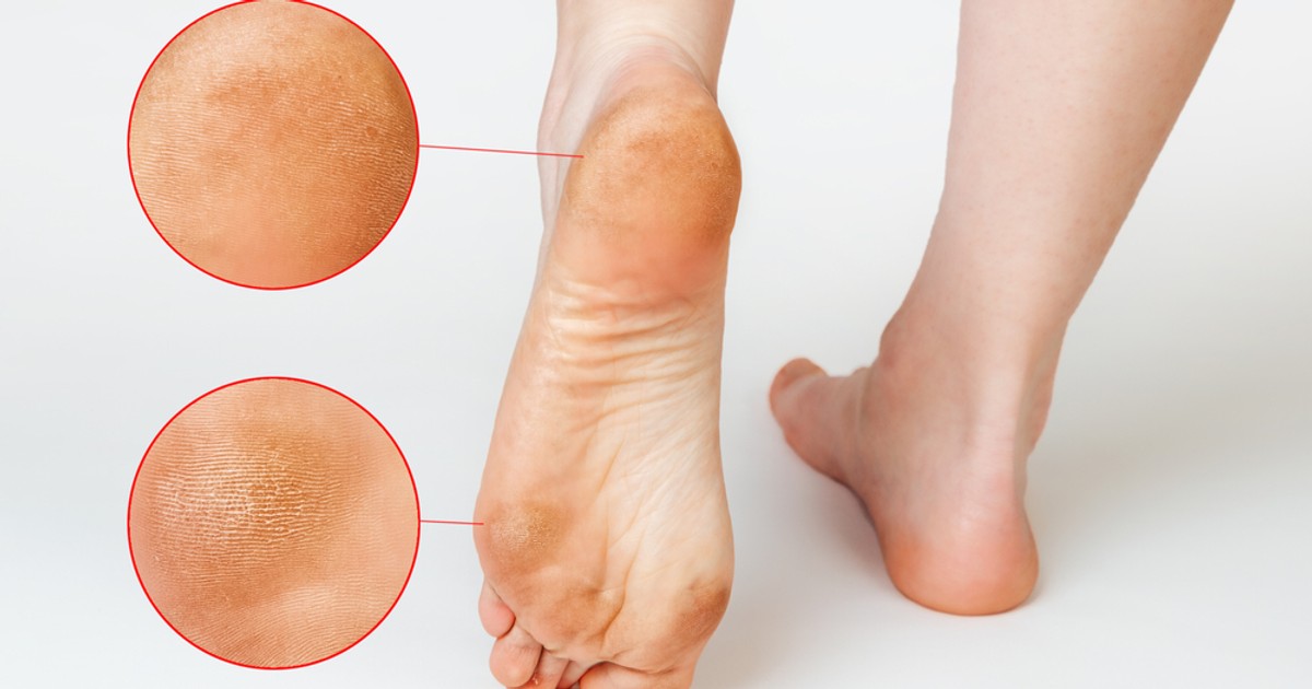 Modzele to szpecące odciski. Najlepsze domowe sposoby na modzele