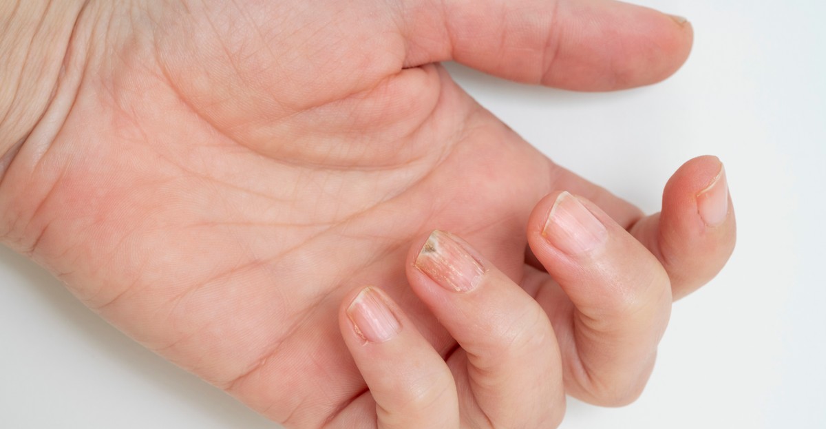 Grzybica paznokcia u rąk - jak się pozbyć wstydliwego problemu i jak ...