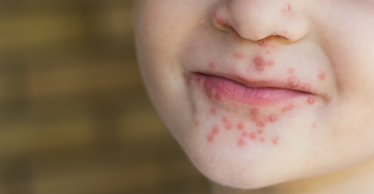 Lekarka: bostonka jest z nami od zawsze, prawie każde dziecko zachoruje