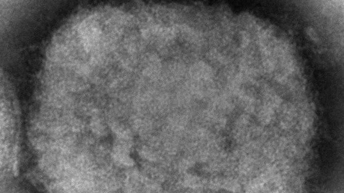 Opičie kiahne na Slovensku: Ako sa môžete nakaziť? Dôležité upozornenie ...