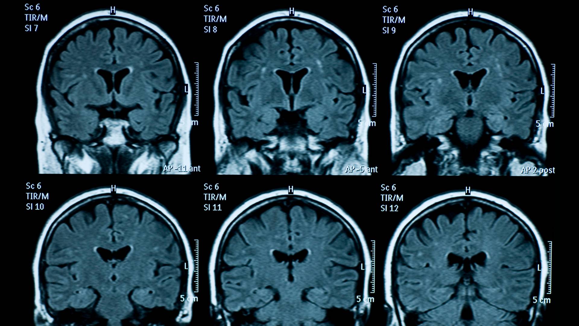 Mind forrófejűek vagyunk: akár 40 fok is lehet az agy hőmérséklete egy ...