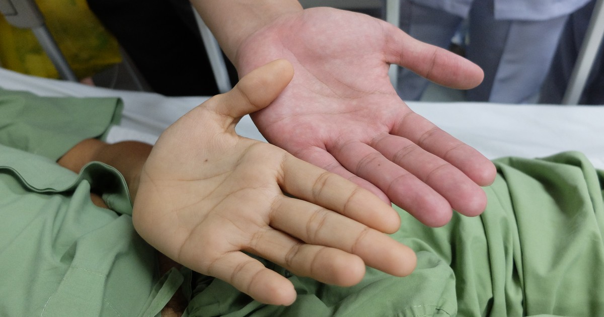 Żółtaczka - objaw który wymaga niezwłocznego leczenia - Zdrowie