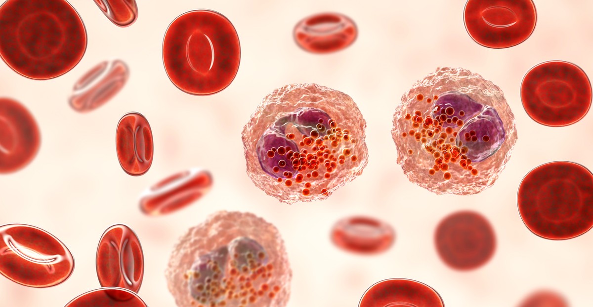 Czym jest eozynofilia? Przyczyny, objawy i leczenie eozynofilii