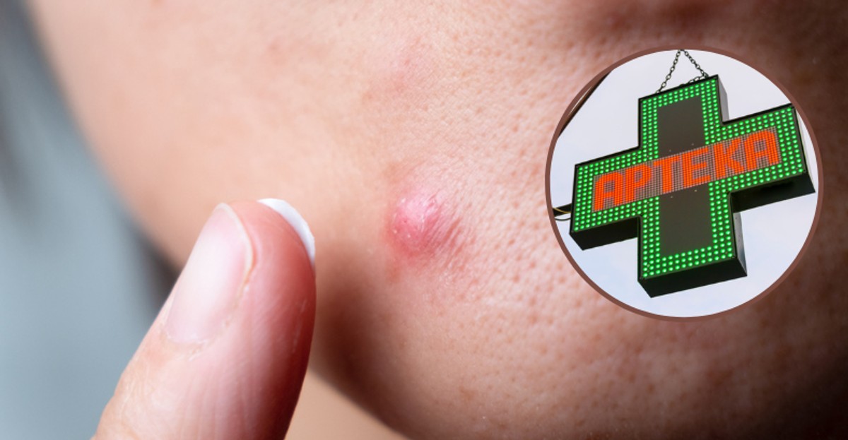 TOP 5 maści z apteki na pryszcze. Ratunek bez recepty za kilka złotych