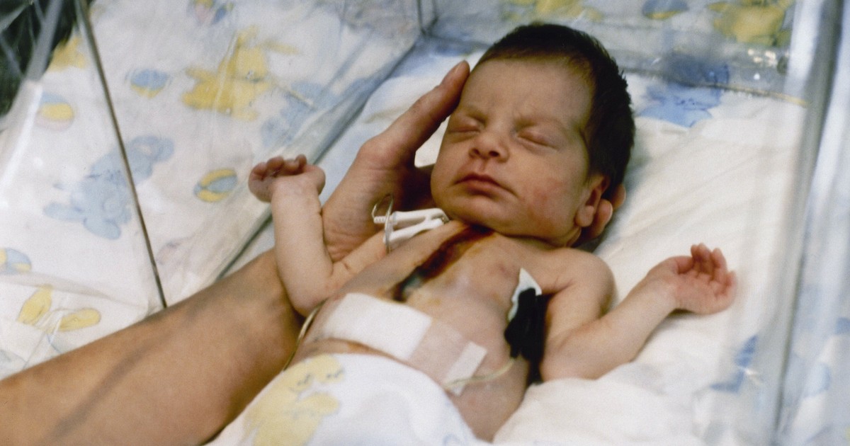 baby Fae. niemowlę z przeszczepionym sercem pawiana