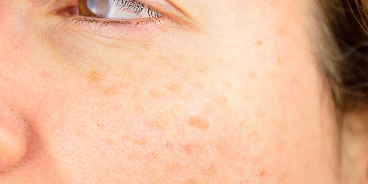 Plamy wątrobowe - wygląd, opalanie, leczenie - Zdrowie