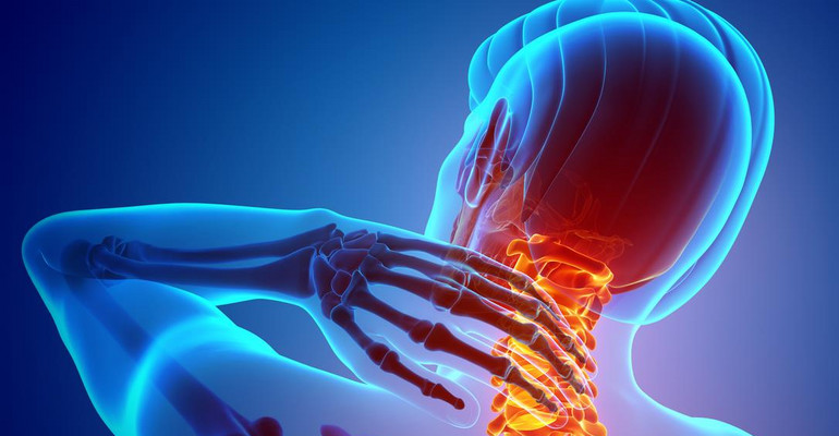 Zniesienie lordozy szyjnej. Czym jest i jak się ją leczy?