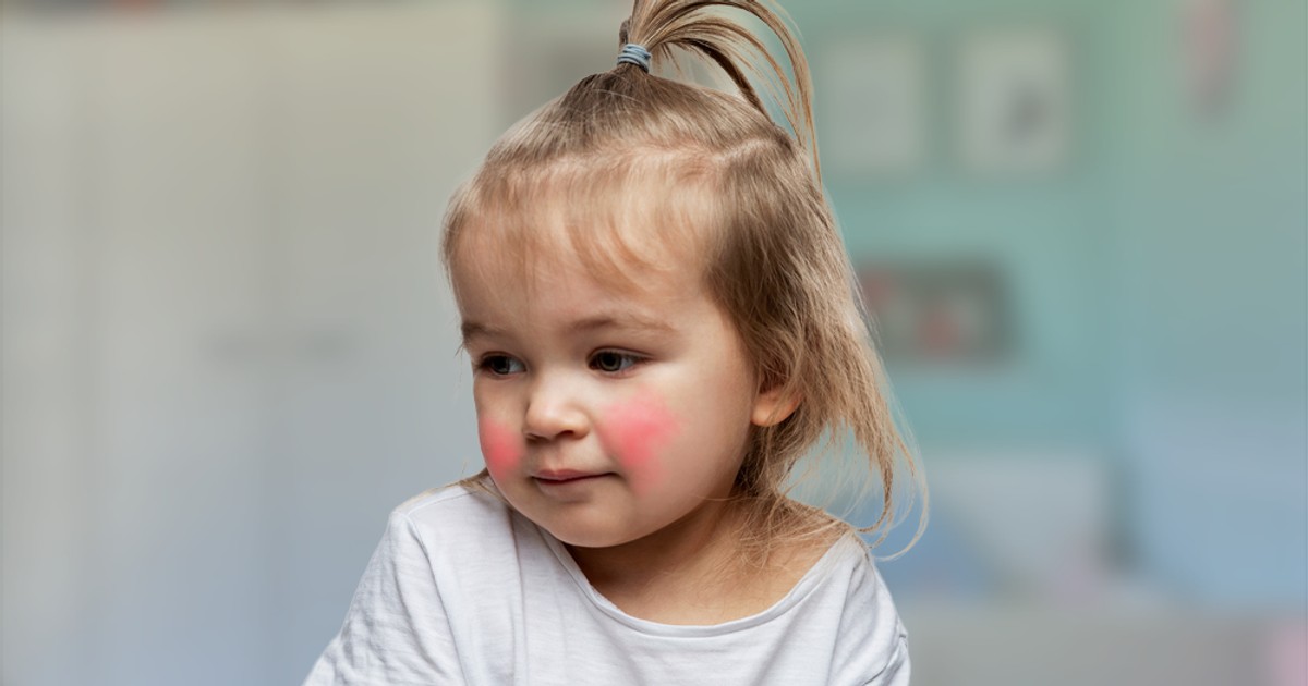 Alergia na białka mleka krowiego u dzieci – wszystko, co musisz wiedzieć