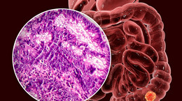 "Jelito grube wypełnia się tysiącami grudek, co nieuchronnie prowadzi ...