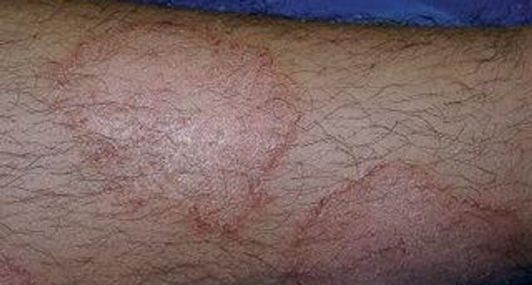 Wyprysk pieniążkowy - przyczyny, objawy i leczenie