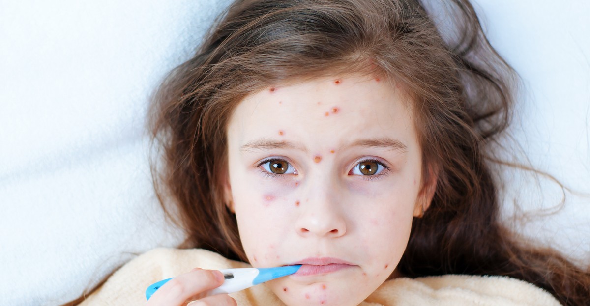 Ospa u dzieci - przyczyny, objawy, sposoby leczenia