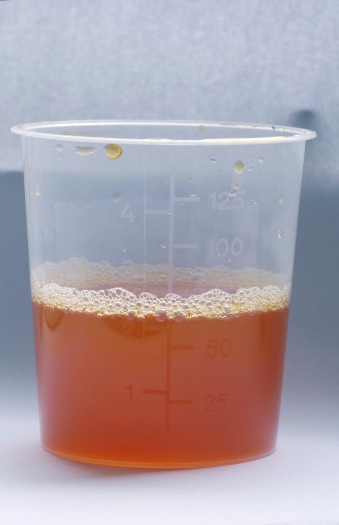 Naša doktorka upozorava: Ako vam je mokraća ovakve boje, odmah se ...