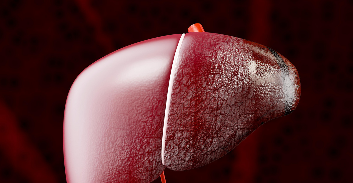 Motylica wątrobowa - pasożyt osiągający nawet 5 cm długości. Jak ...