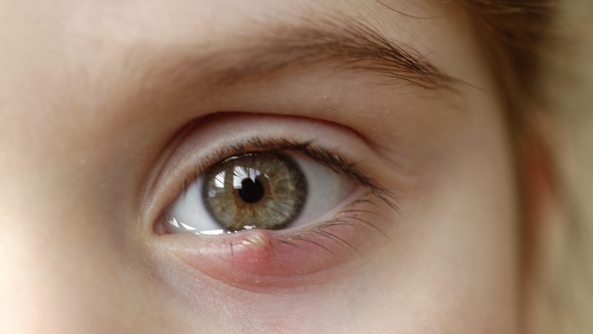Jęczmień na powiece - dlaczego powstaje i jak go leczyć? - Zdrowie