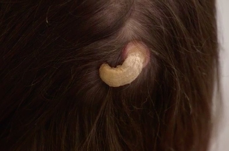 Horn Growing Out Of Head Dr Pimple Popper at Jeremy Rivera blog