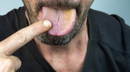 Plamy opadowe - czym są i gdzie najczęściej się lokalizują plamy ...