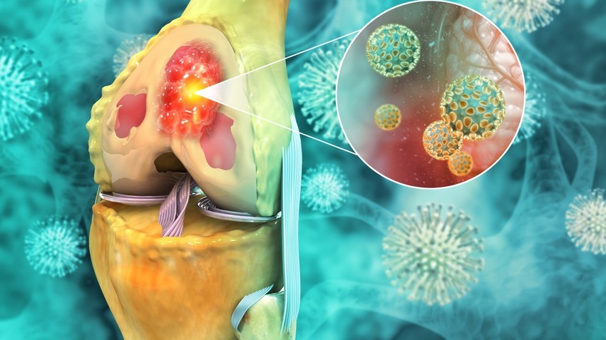 Rosszindulatú csontdaganatok - ezt érdemes tudnia róla - EgészségKalauz