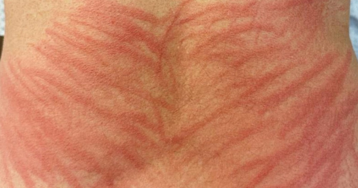A man developed a rash that looked like something had scratched his ...