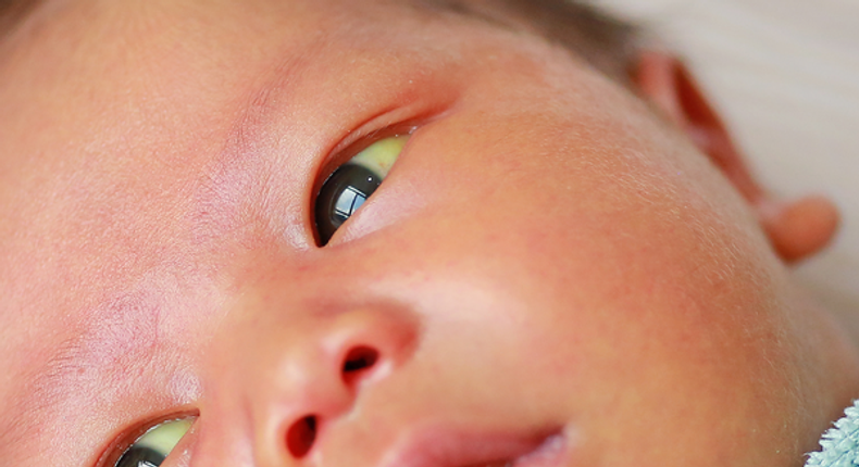 Putting pawpaw water, breast milk in baby's eyes won't cure jaundice | Pulse Nigeria