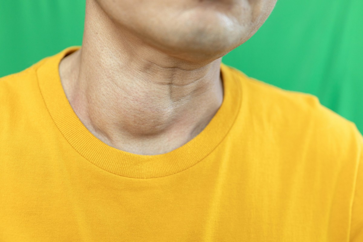 Mikor kell műteni a strúmát? Az endokrinológus válaszol | EgészségKalauz