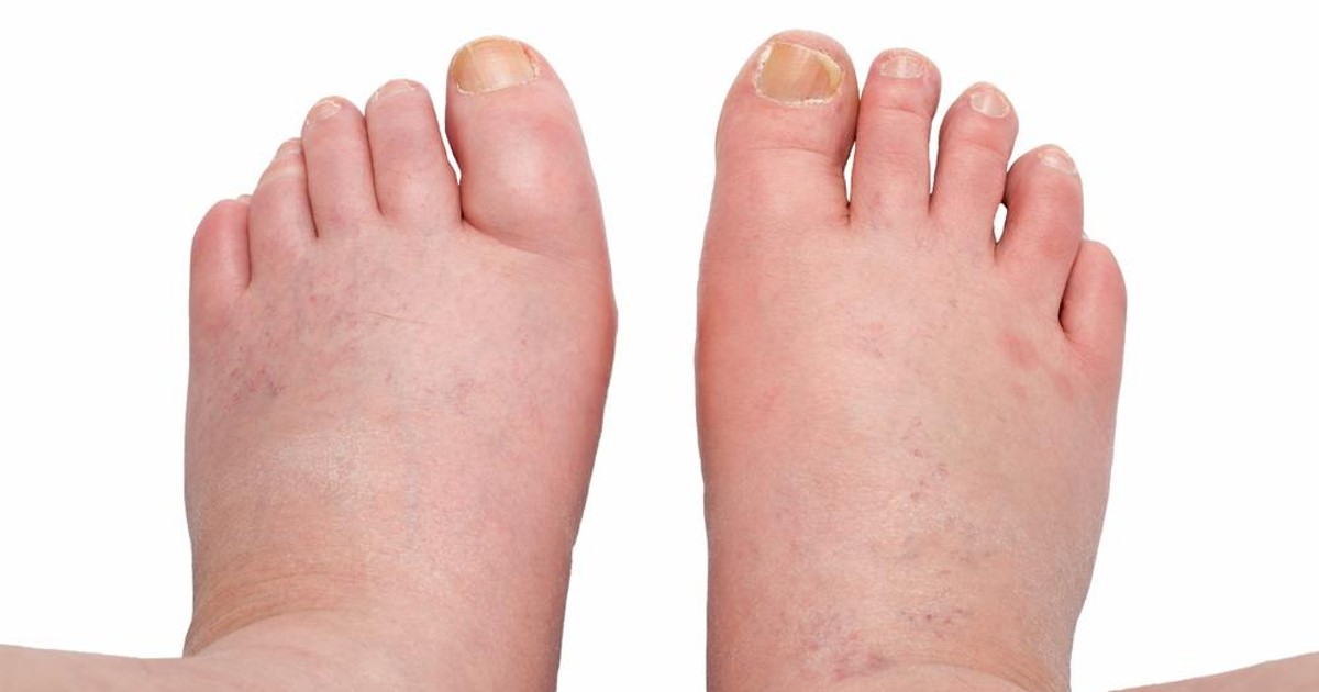 Obrzęk lipidowy - objawy, leczenie. Czym jest lipodemia?