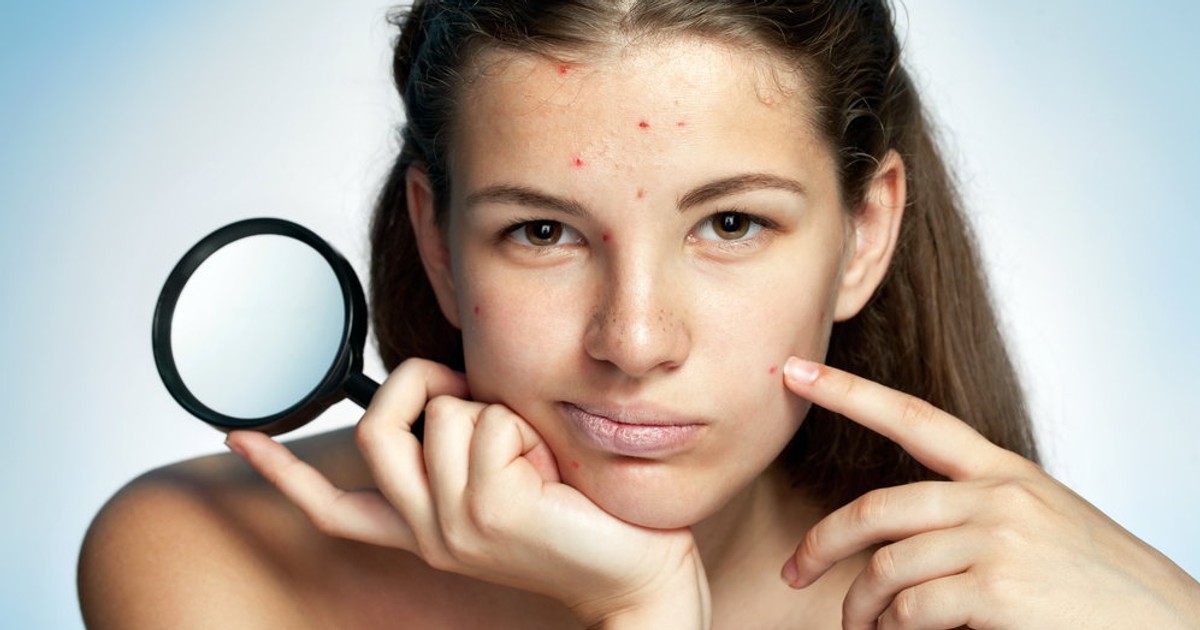 Miejsce ma znaczenie - oceń, gdzie najczęściej masz wypryski, aby ...