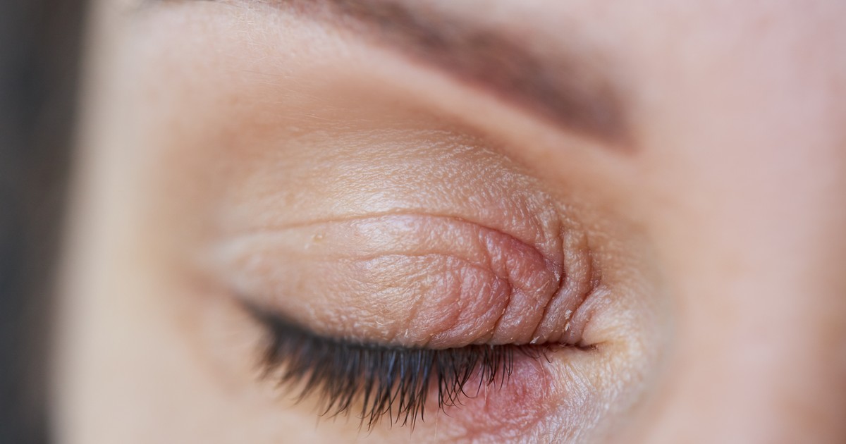 Jak leczyć opryszczkę na powiece? Lekarz wyjaśnia, skąd się bierze